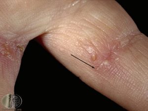 What Does Scabies Look Like? | Scabies home remedies